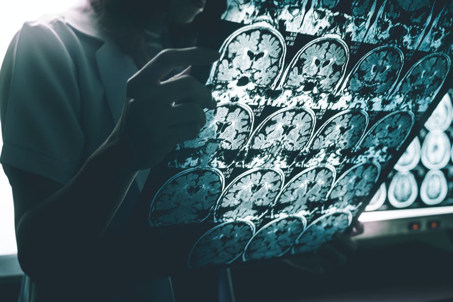 Mbipesha mund të përkeqësojë efektet e Alzhaimerit - Gazeta Si