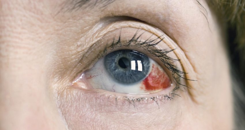 Covid-19 mund të rrisë rrezikun për mpiksje të gjakut në sy - Gazeta Si